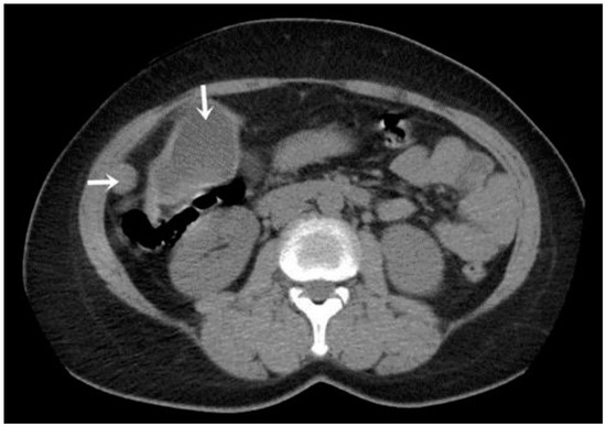 Laparoscopic Management of Multiple Liver, Omental, Mesenteric ...