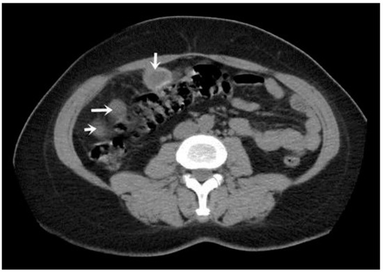 Laparoscopic Management of Multiple Liver, Omental, Mesenteric ...