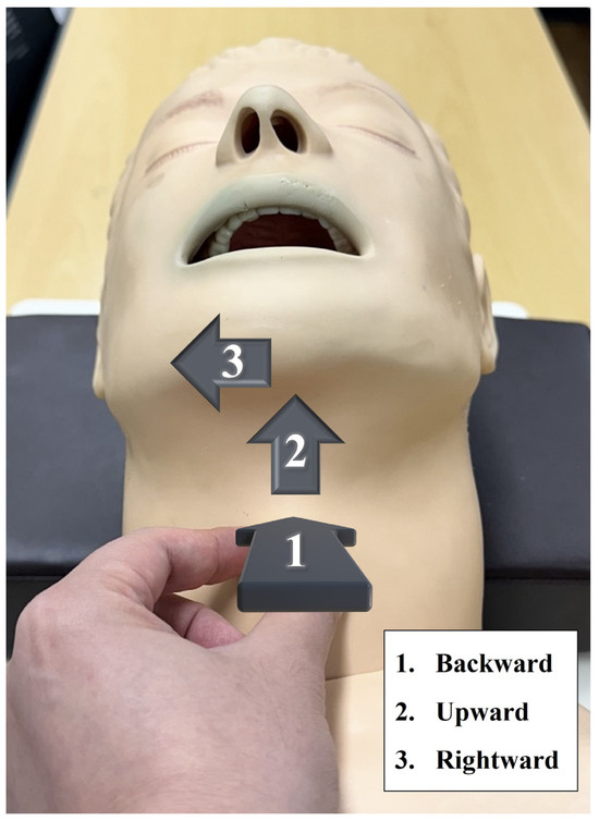 Influence of Curved Video Laryngoscope Blade Sizes and Patient Heights ...