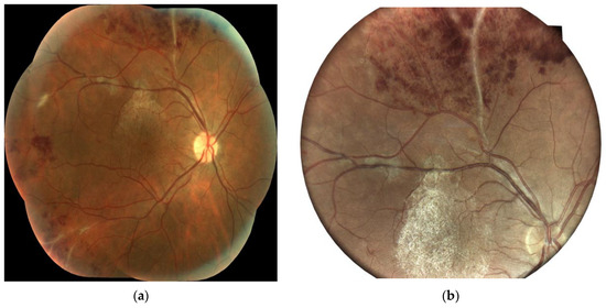 A Multidisciplinary Approach to the Management of Eales Disease: A Case ...