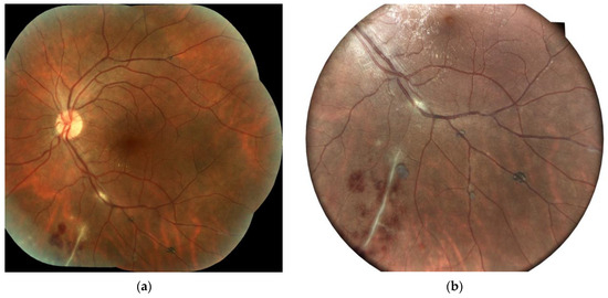 A Multidisciplinary Approach to the Management of Eales Disease: A Case ...