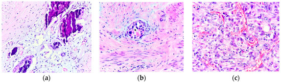 The Impact on Survival of Neoadjuvant Treatment Interruptions in ...