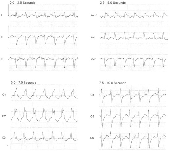 Cardiac Arrest and Complete Heart Block: Complications after Electrical ...