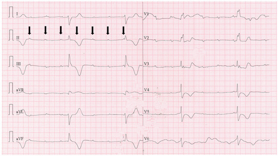 Cardiac Arrest and Complete Heart Block: Complications after Electrical ...