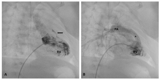 Personalized Approach in Transcatheter Palliation of Congenital Heart ...
