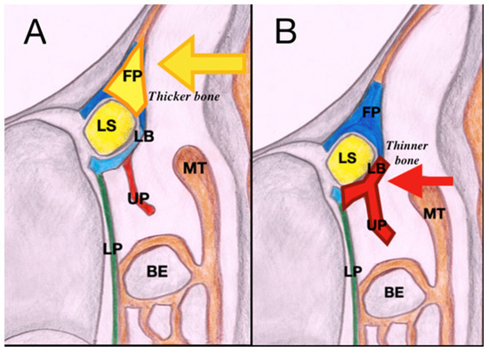 Outcomes of Endoscopic Endonasal Dacryocystorhinostomy in Glaucoma Patients