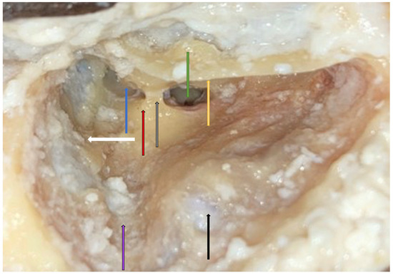 Critical Steps and Common Mistakes during Temporal Bone Dissection: A ...