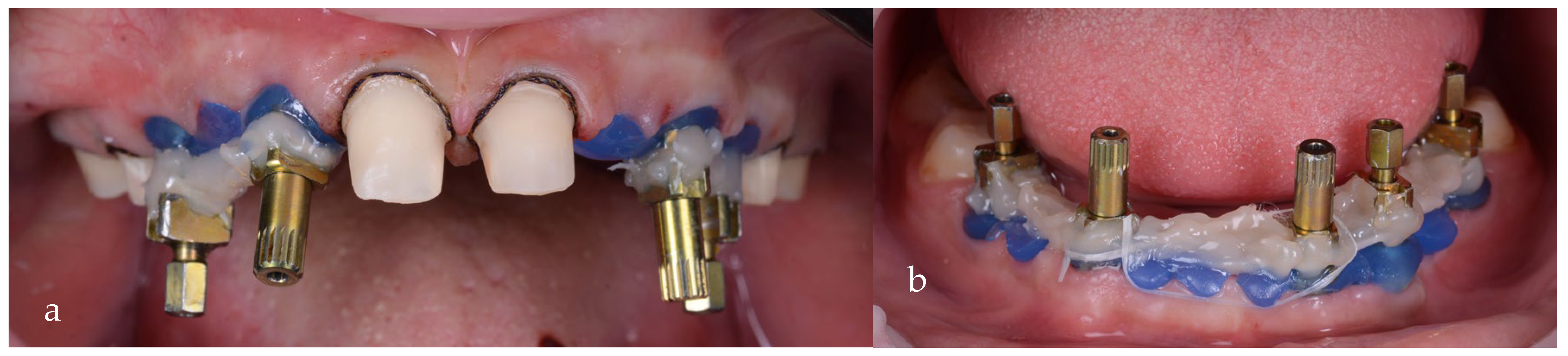 Personalized and Complex Esthetic Oral Rehabilitation in a Case of Non ...