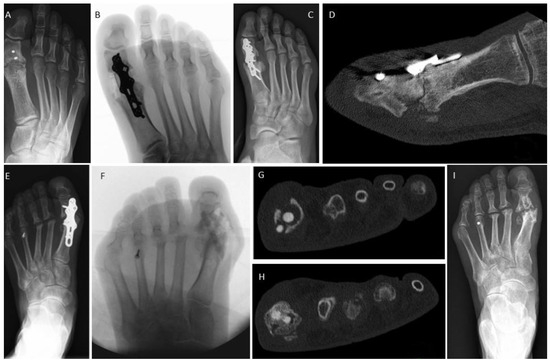 Non-Union Treatment in the Foot, Ankle, and Lower Leg: A Multicenter ...