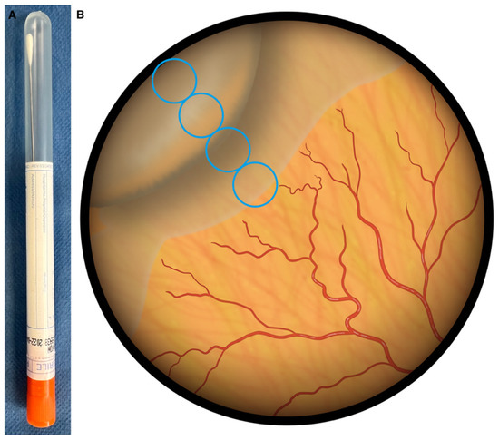 Mechanical Ventilation, Retinal Avascularity and Rate of ...