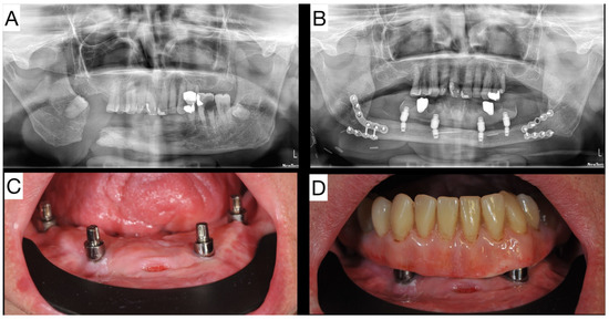 Short and Extra Short Dental Implants in Osseous Microvascular Free ...