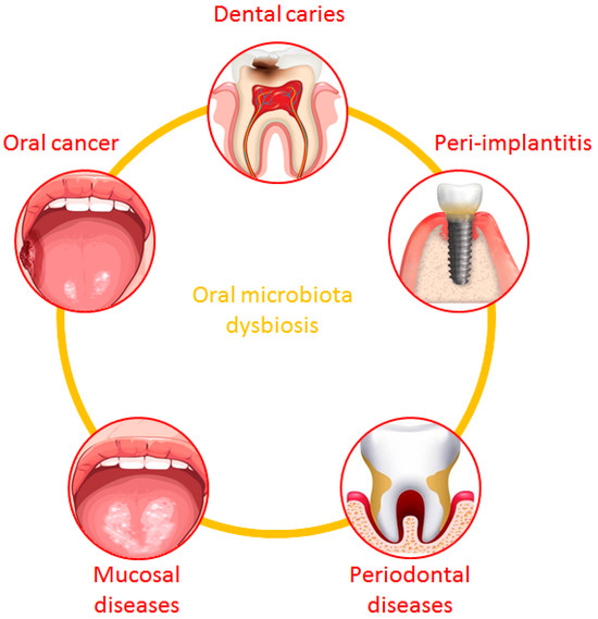 Role of Oral Microbiota Dysbiosis in the Development and Progression of ...