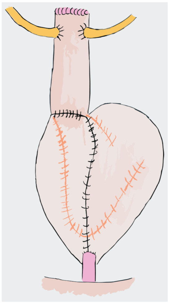 Advances in Urinary Diversion: From Cutaneous Ureterostomy to ...
