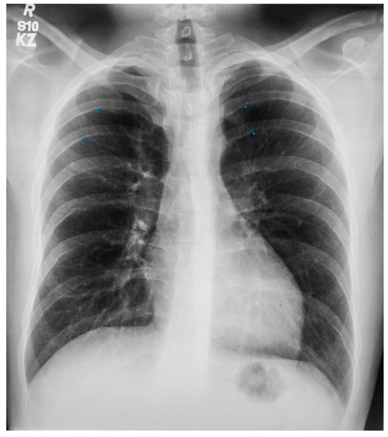 Chest Radiography Pearls in Select Adult Congenital Heart Disease
