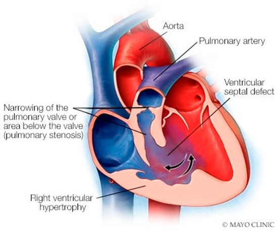 Chest Radiography Pearls in Select Adult Congenital Heart Disease