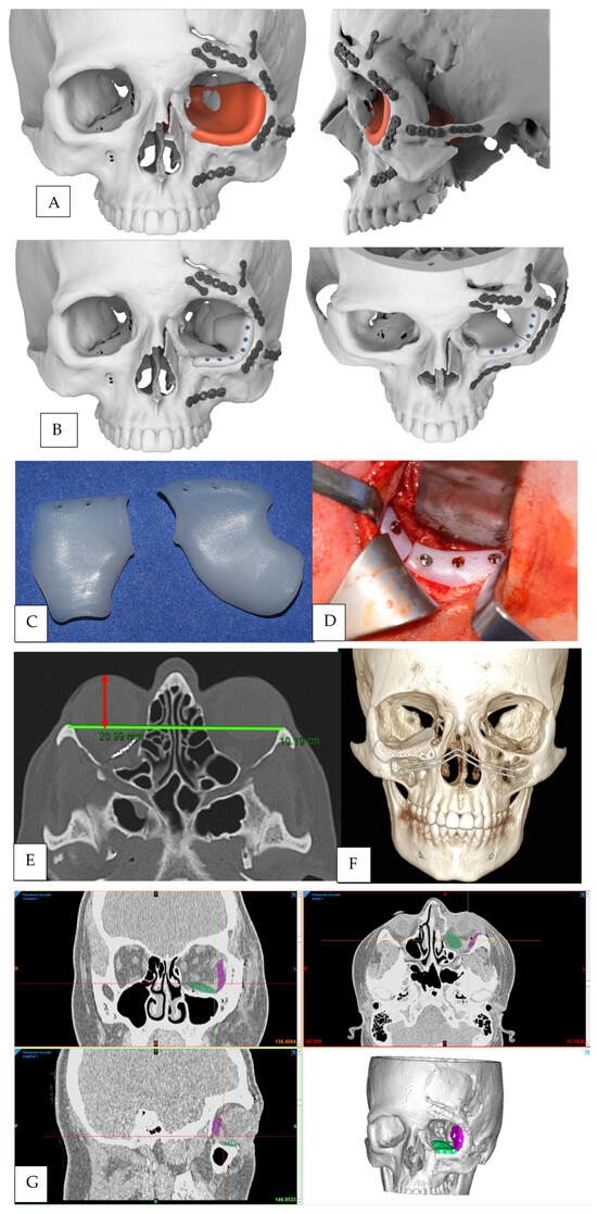 Delayed Orbital Floor Reconstruction Using Mirroring Technique and ...