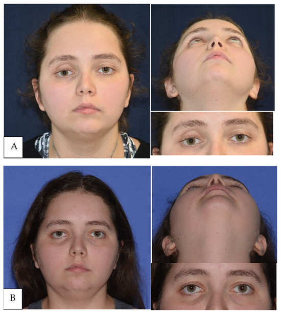 Delayed Orbital Floor Reconstruction Using Mirroring Technique and ...