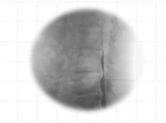 Epidural, Inadvertent Subdural, and Combined Epidural–Subdural ...