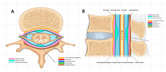 Epidural, Inadvertent Subdural, and Combined Epidural–Subdural ...