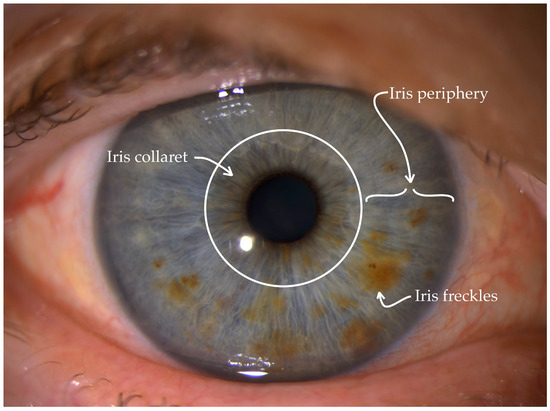 Iris Pigmented Lesions and Risk of Cutaneous Melanoma: Case–Control ...