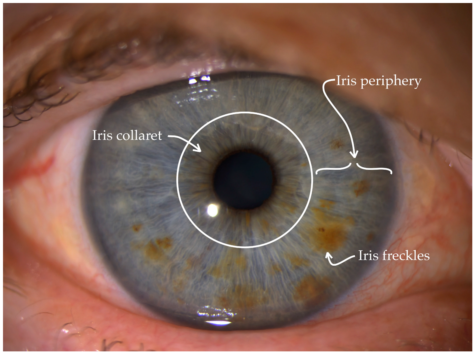 Iris Pigmented Lesions and Risk of Cutaneous Melanoma: Case–Control Study in Lithuania