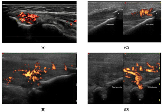 Ultrasonographic Insights into Peripheral Psoriatic Arthritis: Updates ...