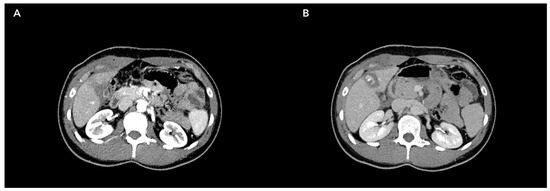 Future Perspectives on Radiomics in Acute Liver Injury and Liver Trauma