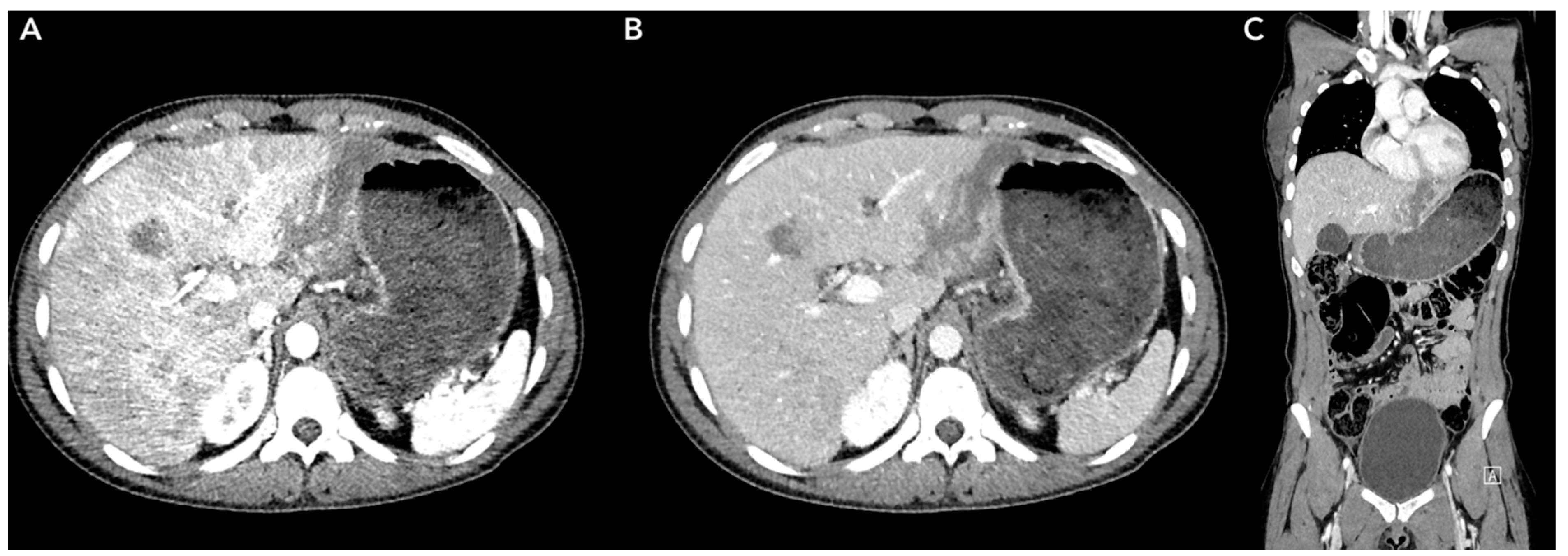Future Perspectives on Radiomics in Acute Liver Injury and Liver Trauma