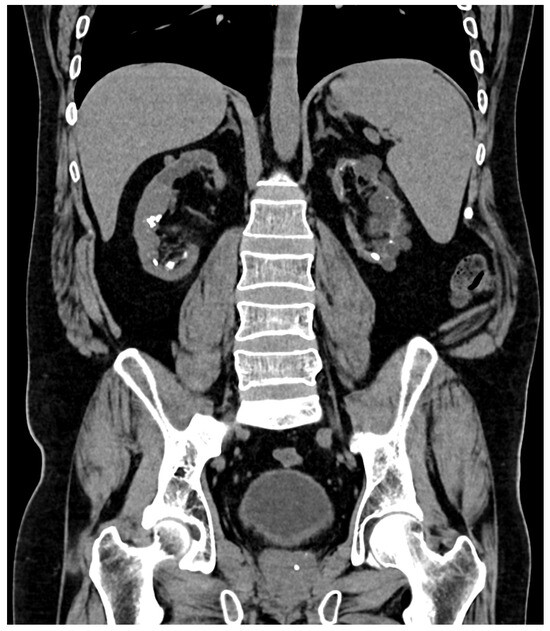 Dent’s Disease: A Cause of Monogenic Kidney Stones and Nephrocalcinosis