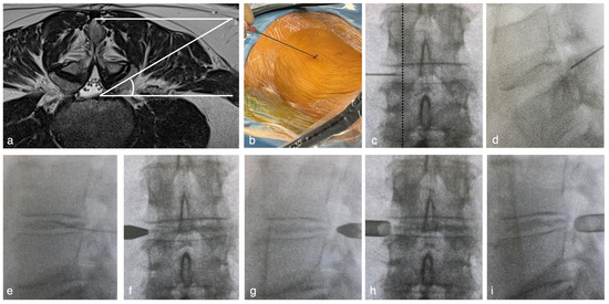 Jpm Free Full Text Enhancing Transforaminal Full Endoscopic