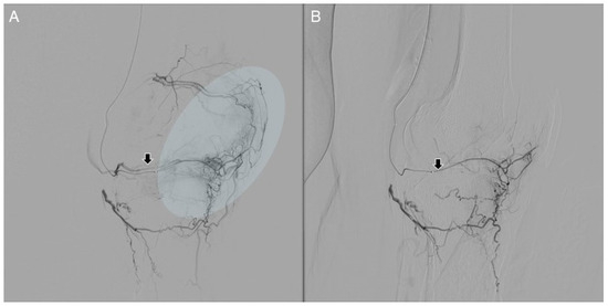 Genicular Artery Embolization: A New Tool for the Management of ...