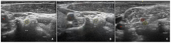 Ultrasound-Guided Cervical Selective Nerve Root Block versus ...