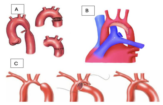 The Management of Aortic Coarctation Associated with Hypoplastic Arches and Particular Arch ...