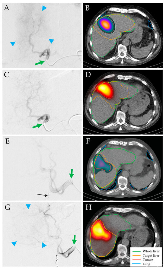 Clinical Results of Holmium-166 Radioembolization with Personalized Dosimetry for the Treatment ...