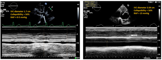 Point of Care Ultrasound (POCUS) in the Management of Heart Failure: A ...
