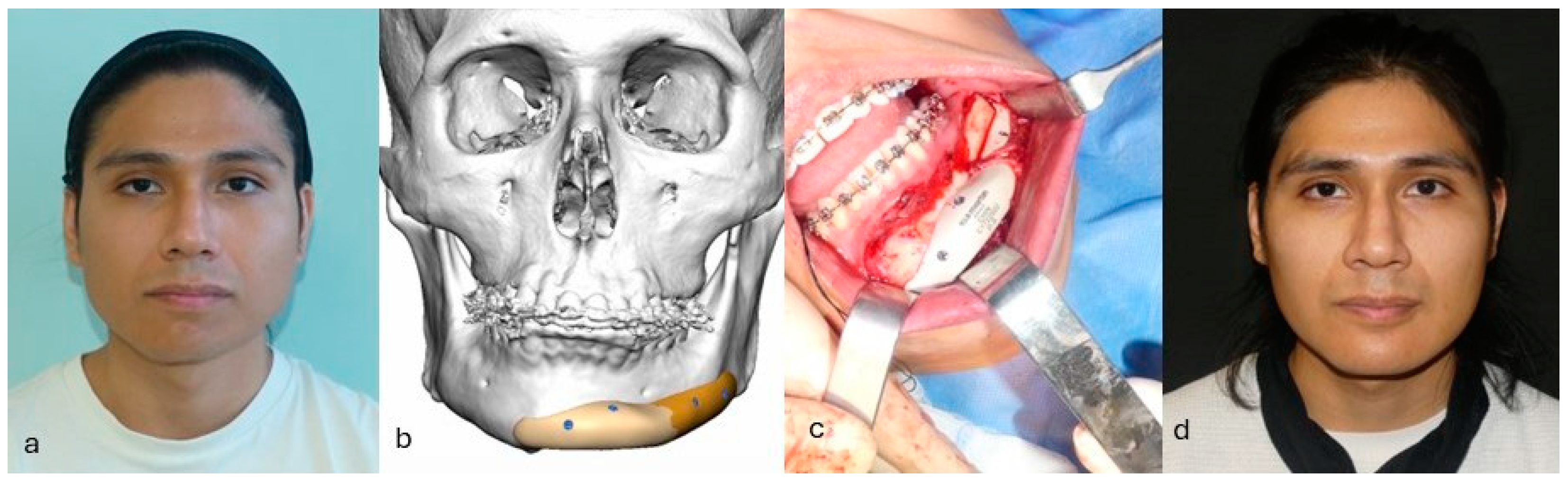 JPM | Free Full-Text | Cranio-Maxillo-Facial Reconstruction with ...