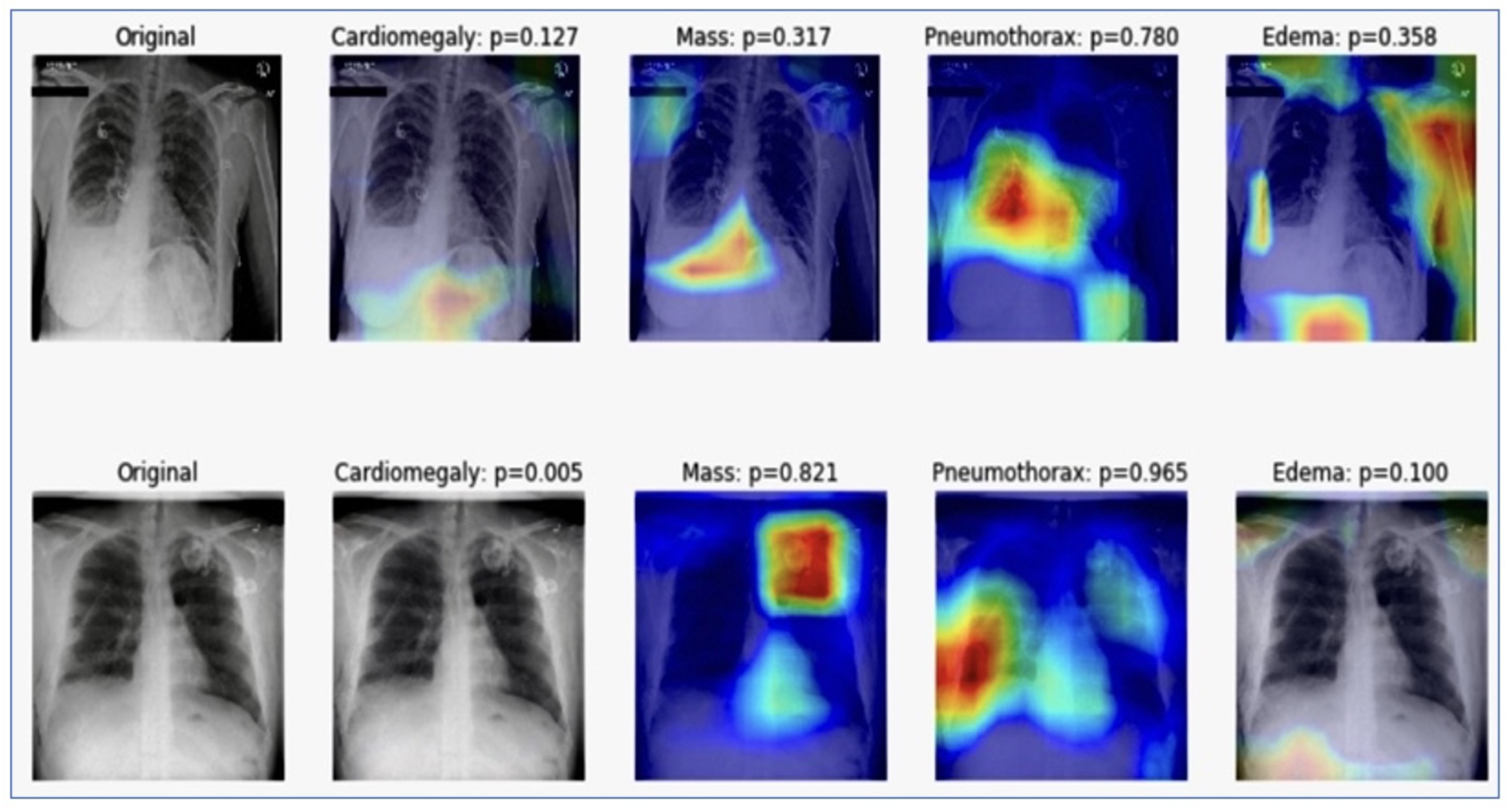 AI-Driven Thoracic X-ray Diagnostics: Transformative Transfer Learning ...