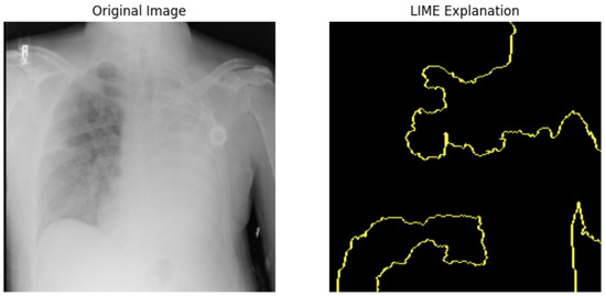 AI-Driven Thoracic X-ray Diagnostics: Transformative Transfer Learning ...