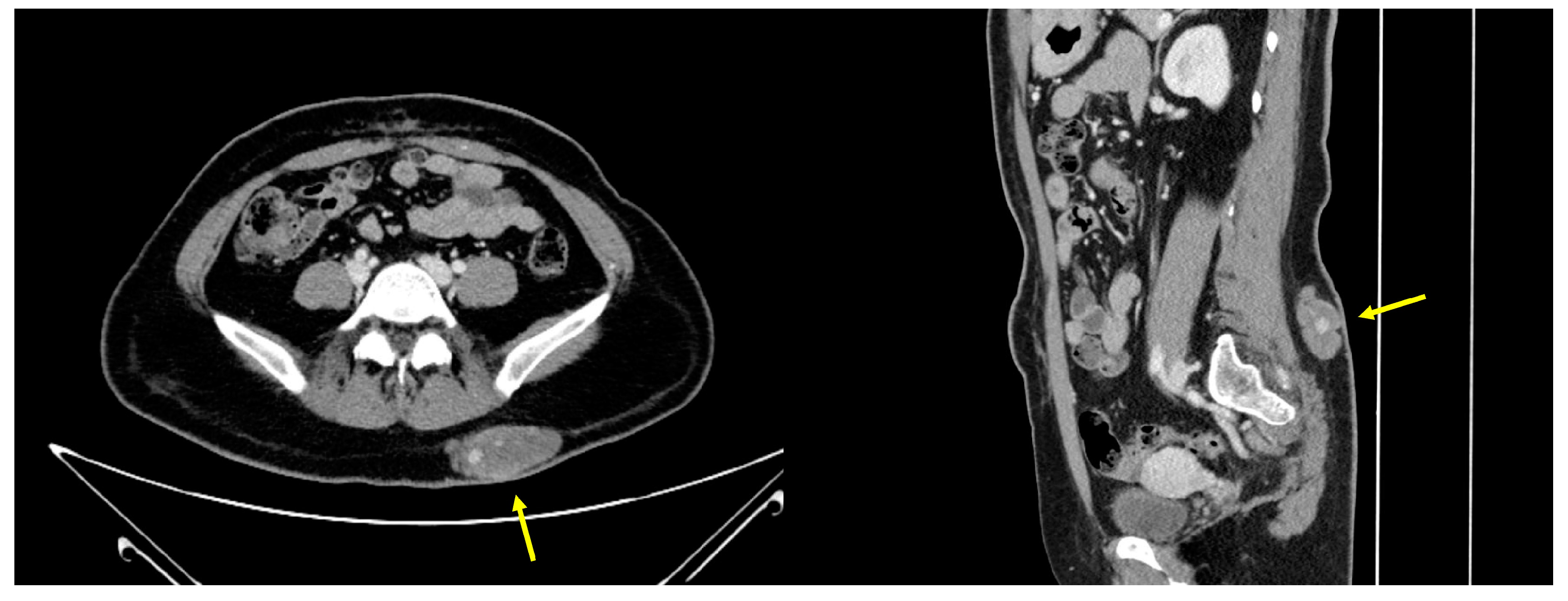 Superficial Anaplastic Lymphoma Kinase-Rearranged Myxoid Spindle Cell ...