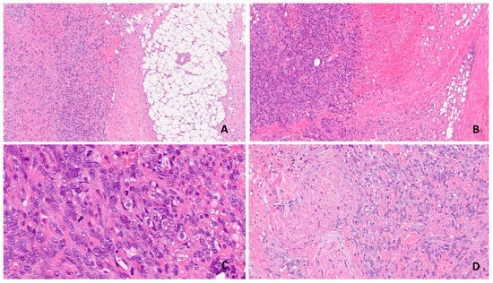 Radiation-Associated Angiosarcoma of the Breast: The State of the Art ...