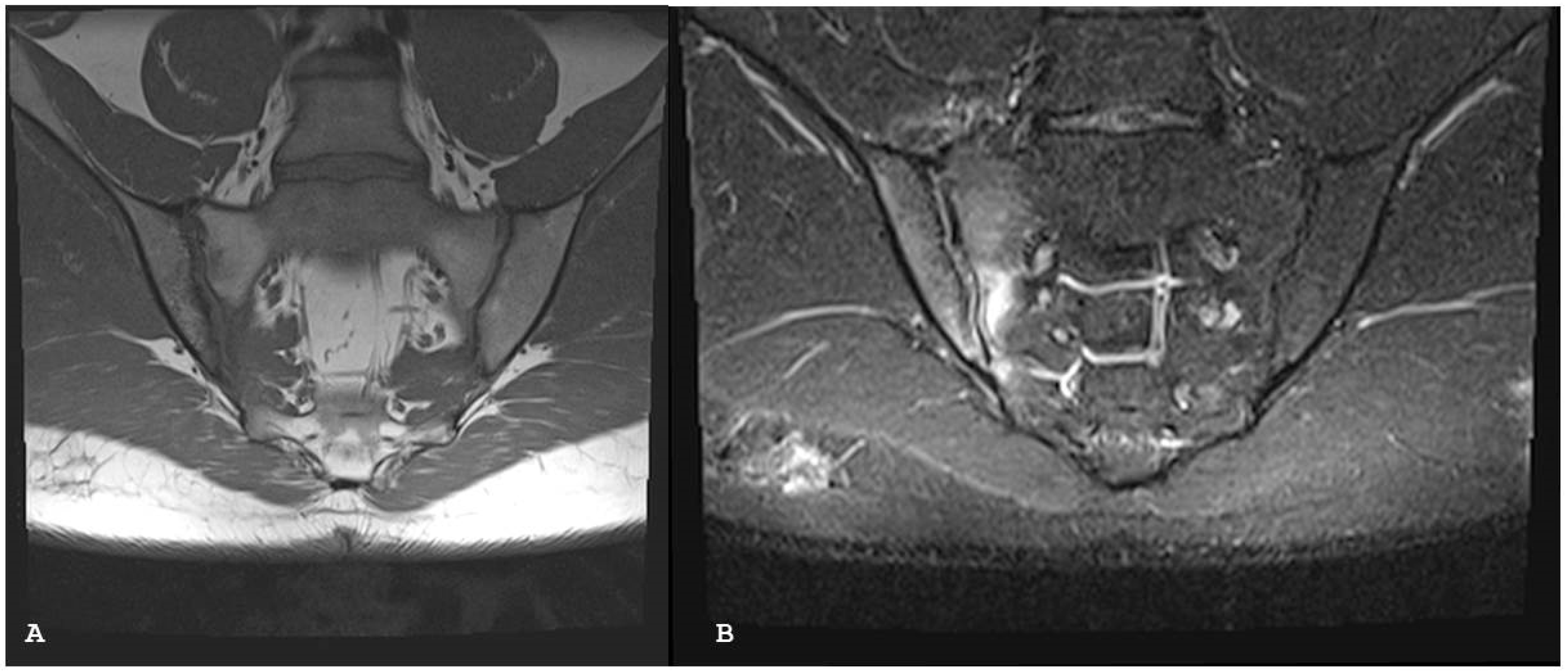 Imaging of Sacroiliac Pain: The Current State-of-the-Art
