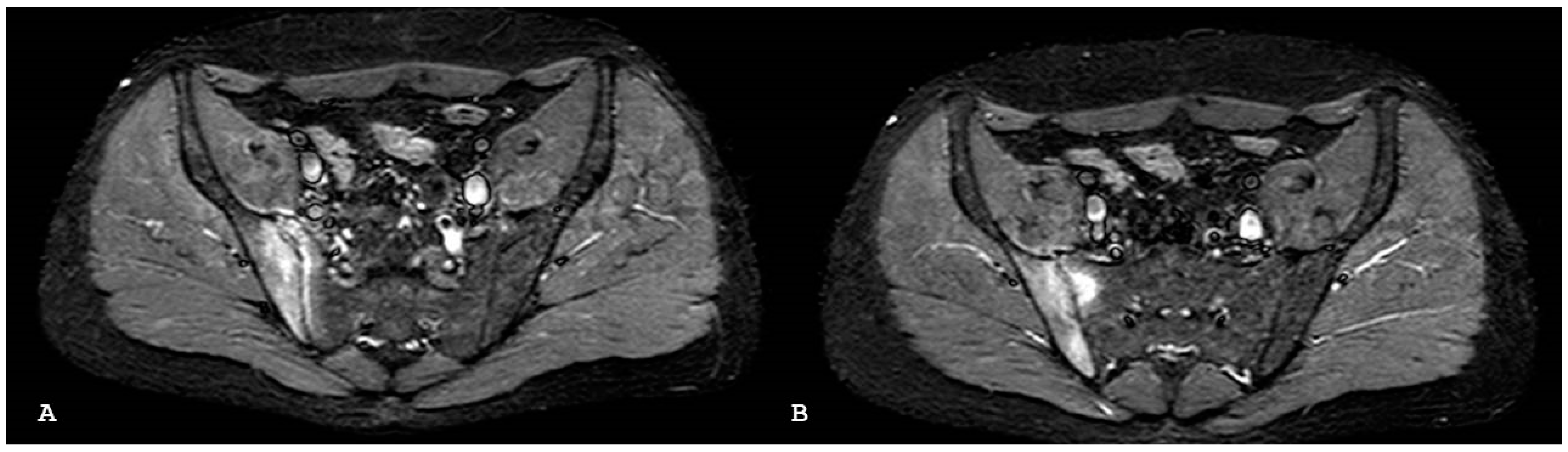 Imaging of Sacroiliac Pain: The Current State-of-the-Art