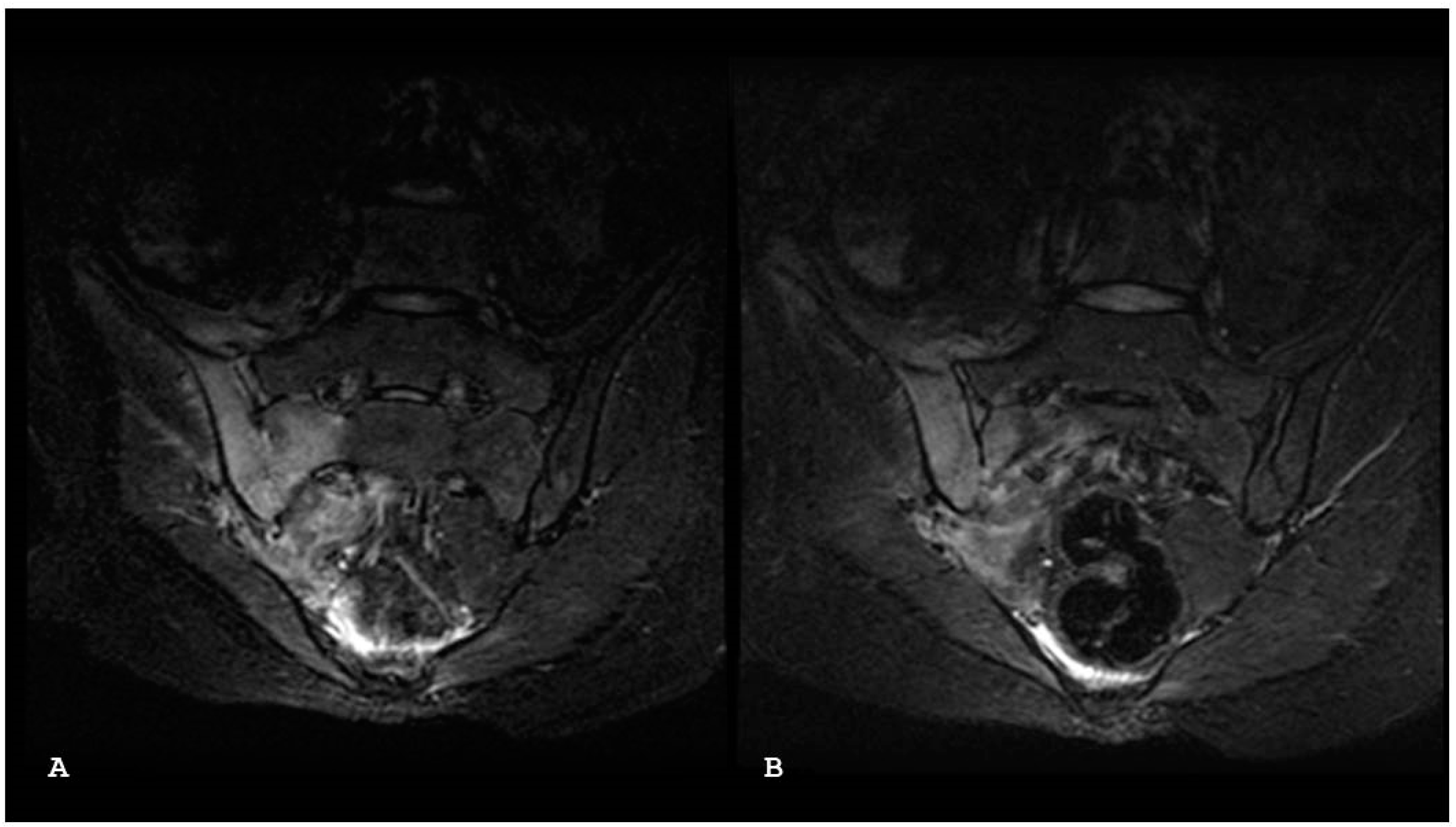 Sacroiliac Joint Pain Mri Radiologia Brasileira Sacroiliíte: