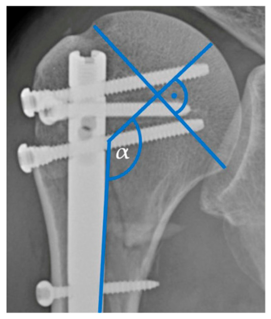 Head–Shaft Angle Influences Isometric Shoulder Strength Levels after ...