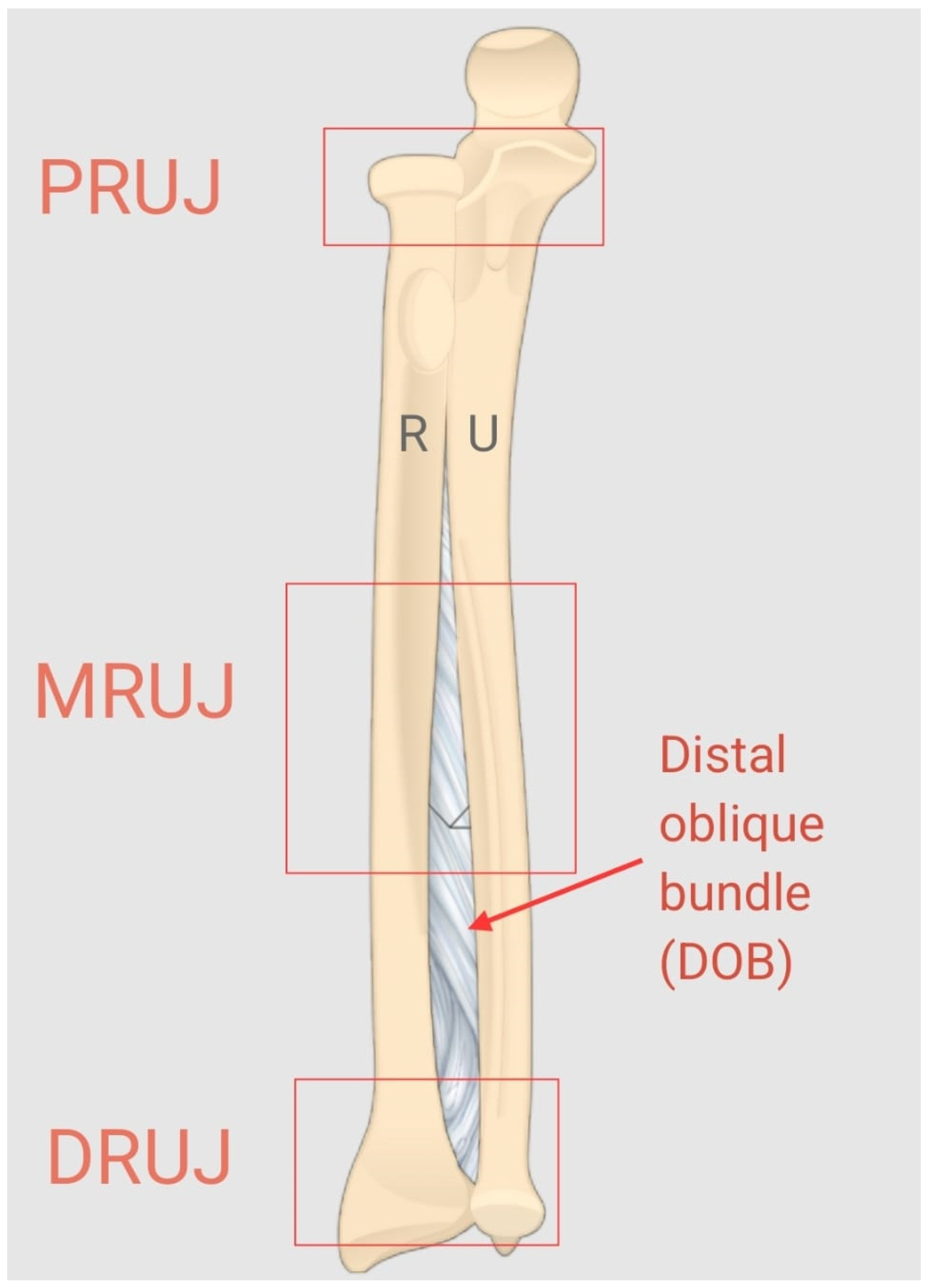 Advancements in Diagnosis and Management of Distal Radioulnar Joint Instability: A Comprehensive ...