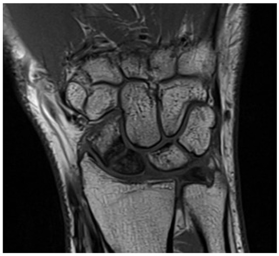 Advancements in Diagnosis and Management of Distal Radioulnar Joint ...