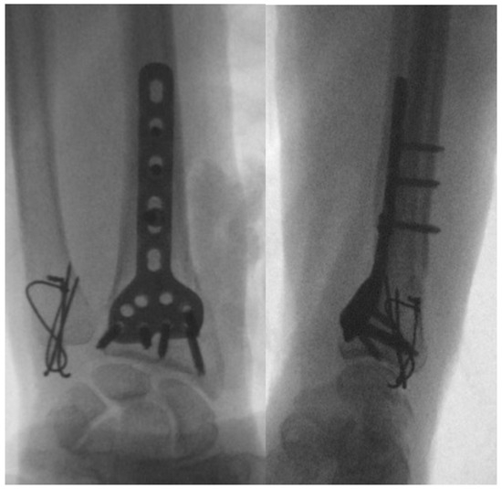 Advancements in Diagnosis and Management of Distal Radioulnar Joint ...