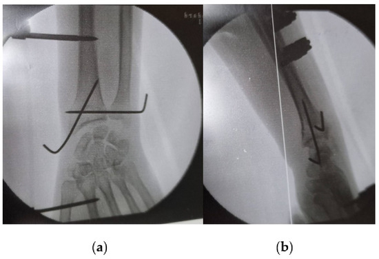 Advancements in Diagnosis and Management of Distal Radioulnar Joint ...