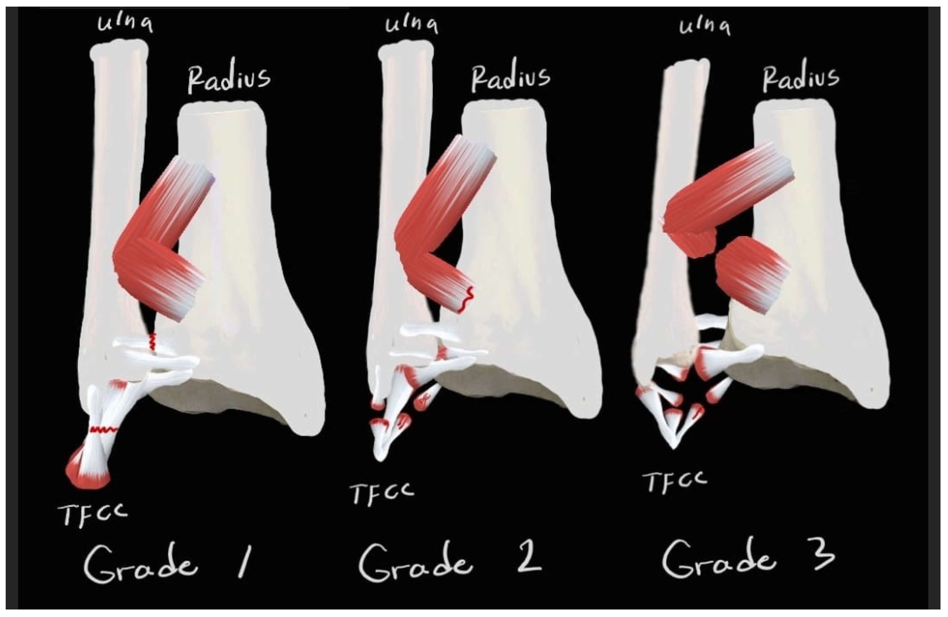 Advancements in Diagnosis and Management of Distal Radioulnar Joint Instability: A Comprehensive ...