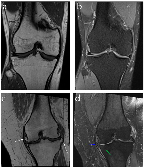 Minimally Invasive Therapies for Knee Osteoarthritis